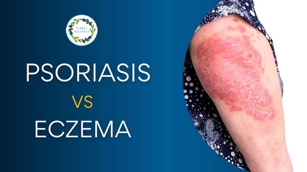 Psoriasis vs Eczema - Organic Health Solutions